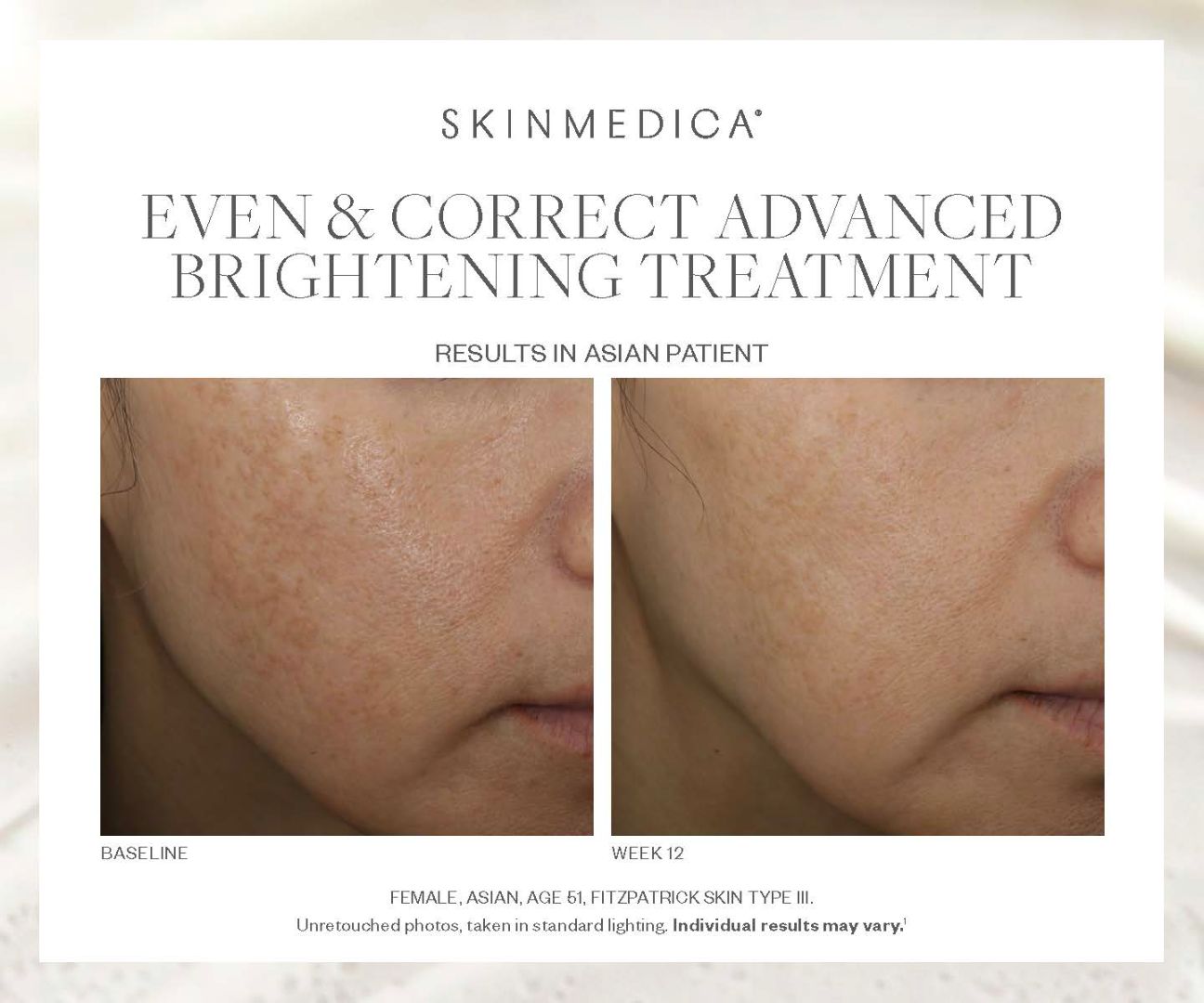 SkinMedica SkinMedica Even & Correct Advanced Brightening Treatment ...